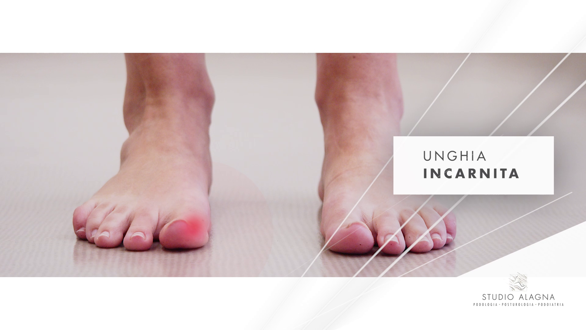 Unghia incarnita Palermo - Studio Alagna