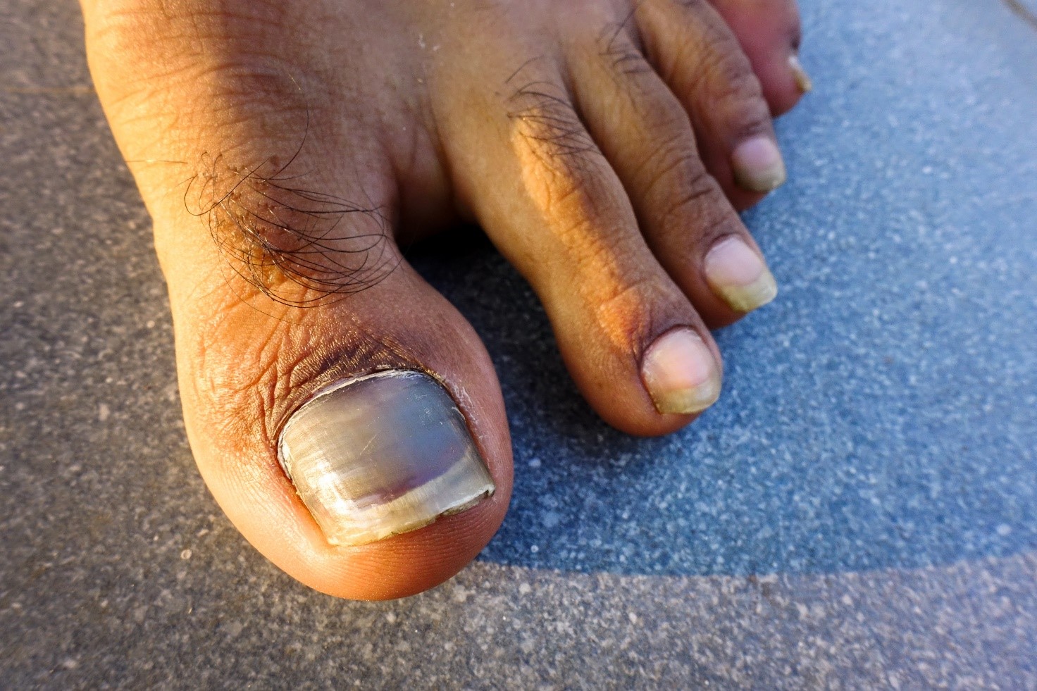 Come curare l'unghia del piede caduta o quasi staccata - Studio Alagna