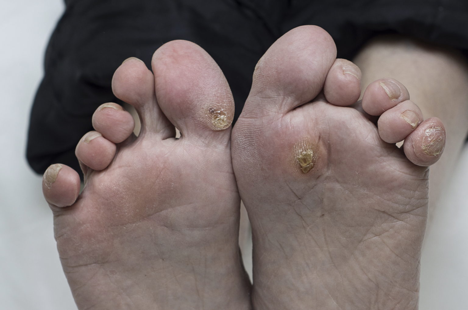 Tiloma plantare, Occhio di Pernice e tiloma dorsale. Cosa sono ...